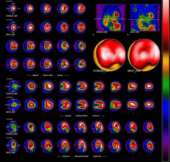 心肌灌流影像分析報告系統 - EverFortune.ai