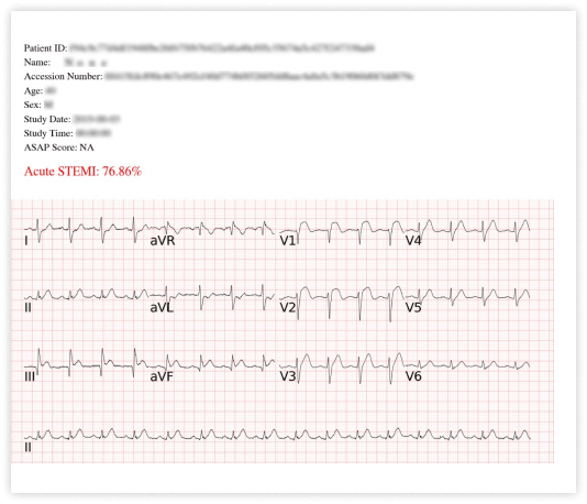 急性心肌梗塞偵測軟體 - EverFortune.ai
