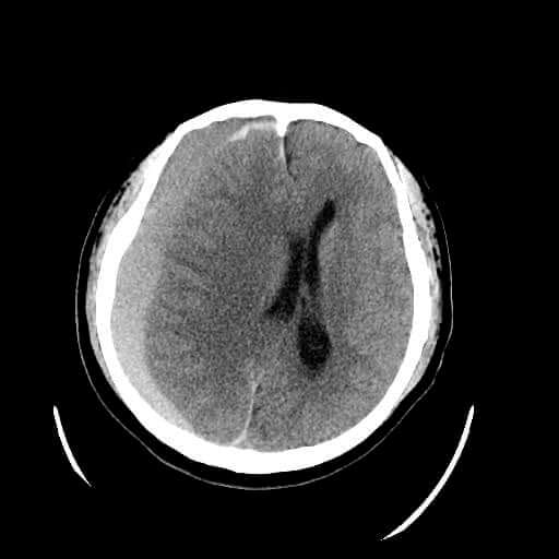 腦出血檢測系統 - EverFortune.ai