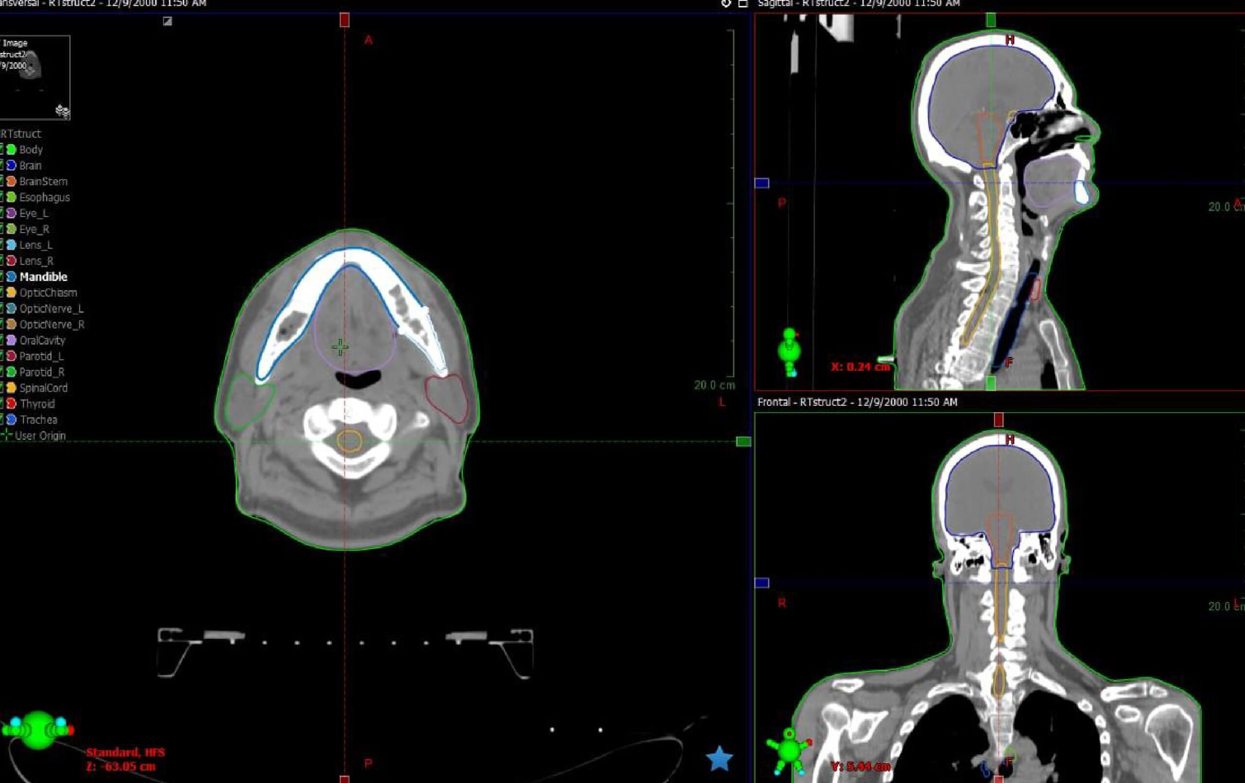 放射治療器官勾勒系統 - EverFortune.ai